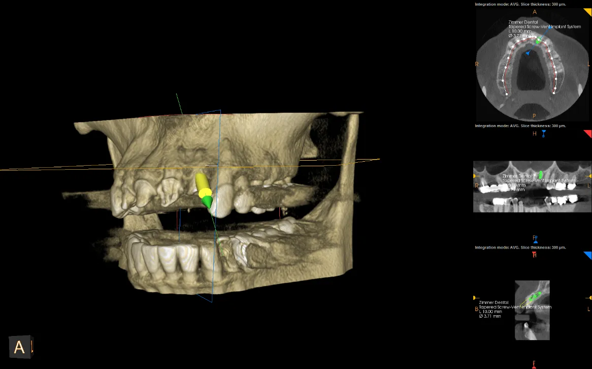 Understanding Palatal Obturators and How They Can Address Openings in ...